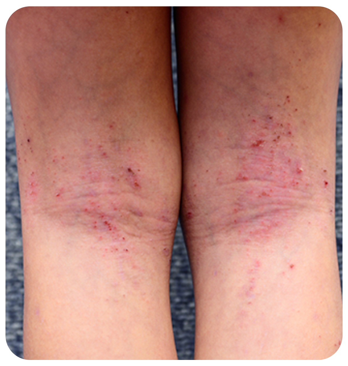 Skin Irritation & Eczema – Kidskin