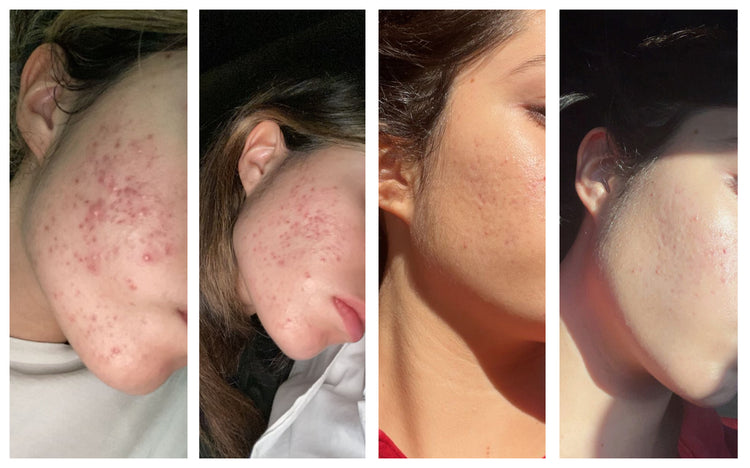 Kidskin Safe, Effective Skincare for Kids, Pre-Teens & Teens